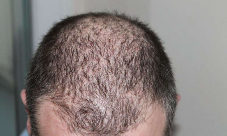 Symptoms of Hair Loss in Teenagers and How to Deal With It?